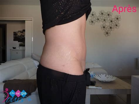 Abdominoplastie Tunisie Prix Proc Dure Tunisie