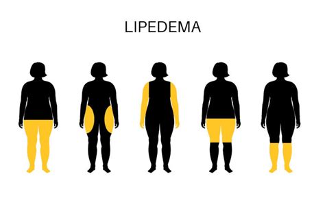 Diagnose Lipödem Barrierefrei Das Online Magazin