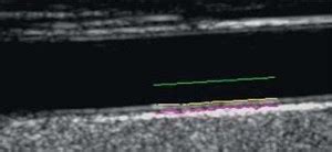 Carotid Intima Media Thickness Cimt Peter Yan Cardiology Clinic