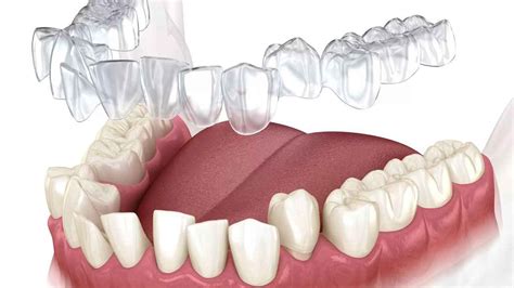 Ortodonti ve ortodontist nedir Şeffaf Plak Tedavisi Akdeniz Telgraf
