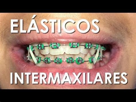 Usos Y Funciones De Las Ligas Elasticas En Los Brackets YouTube
