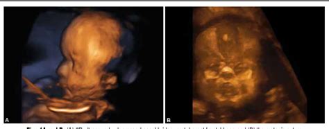 Figure 1 From Apert Syndrome In The Era Of Prenatal Diagnosis
