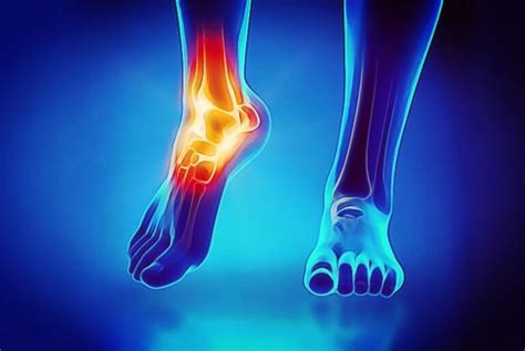 Como ocorre a Lesão Ligamentar do Tornozelo Dr Adriano Leonardi