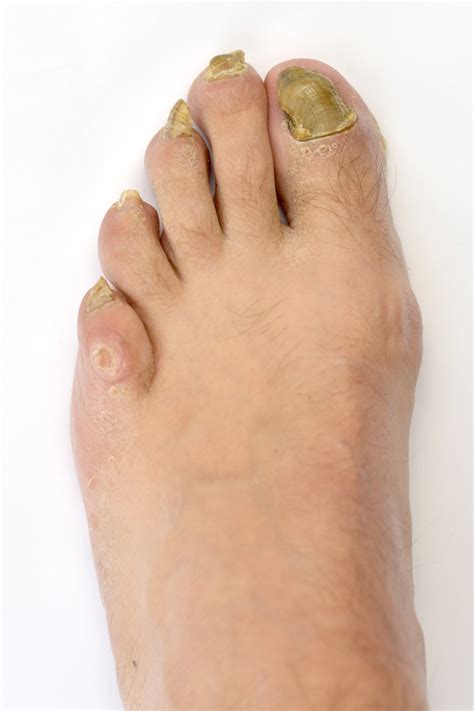 Mycoses du pied peut on les prévenir