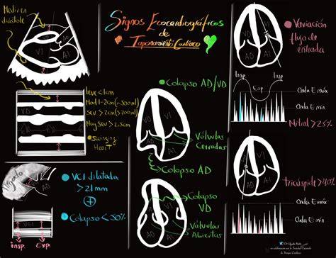 Signos ecocardiográficos de taponamiento cardíaco