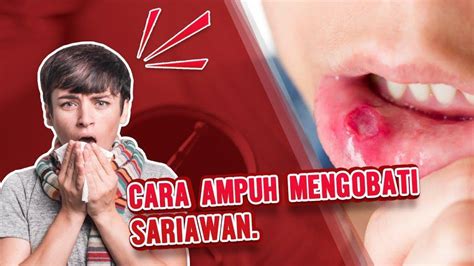 5 Cara Mudah Dan Efektif Mengatasi Sariawan Dengan Cepat Hanya