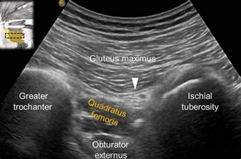 Obturator Internus Muscle Ultrasound
