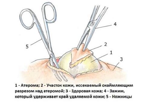 Что делать при кисте на половой губе фото презентация