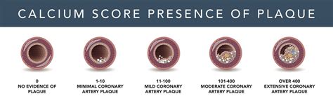 Coronary Artery Calcium Score Kippax Medical Imaging