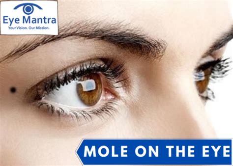 Mole Under Eye
