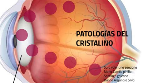 Ciro diapositiva Pornografía facoesclerosis en el ojo Seminario