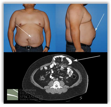 Hernia Types Umbilical California Hernia Specialists