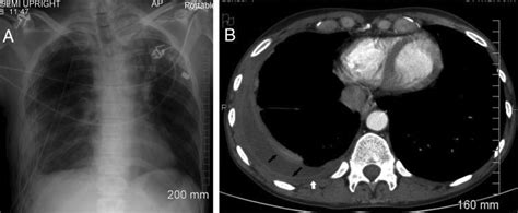 Interventional Management Of Pleural Infections CHEST
