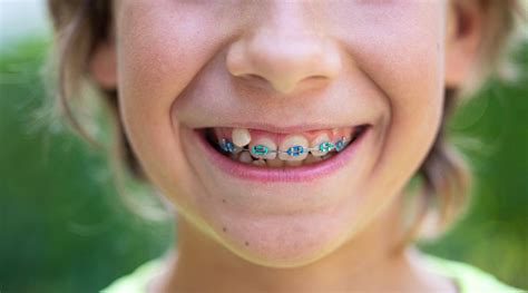 Ortodoncia infantil lo que debes saber del tratamiento para niños