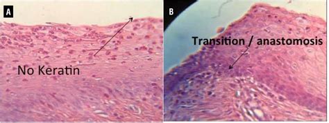 Stratified Squamous Epithelium Non Keratinized Vs Keratinized