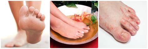 Hongos En Los Pies Qu Son C Mo Aparecen Y Remedios Caseros