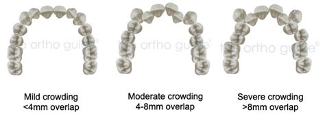 Crowding The Ortho Guide