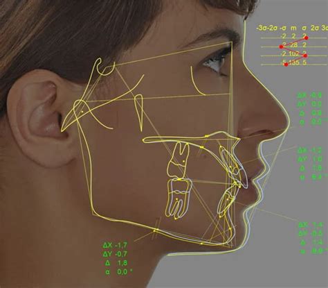 Analiza Cefalometryczna Romexis Unity Stomatologiczne Premium Cbct