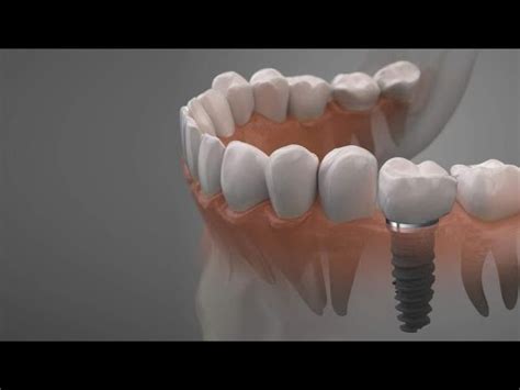 EL DOCTOR EN CASA TV TÉCNICAS PARA COLOCACIÓN DE IMPLANTES DENTALES