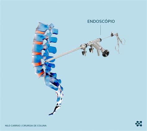Cirurgia Minimamente Invasiva Da Coluna Vertebral Dr Nilo Carrijo
