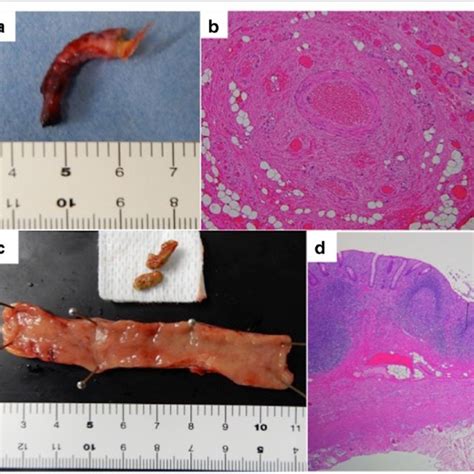 Macroscopic And Pathological Findings Of The Resected Specimens A
