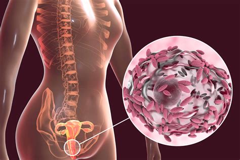 Vaginosis Bacteriana Asociada Con Infecciones Persistentes De Virus Del