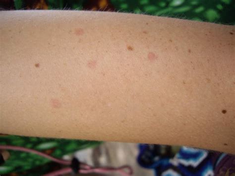 Petechiae Pinprick Red Dots On Skin Not Itchy Causes And Treatment Of