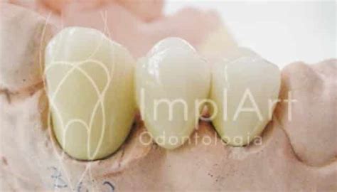 Protese Fixa Metaloceramica 3 Dentes 50kb ImplArt