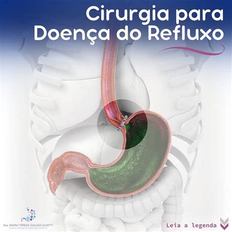 Cirurgia para doença do refluxo Dra Maria Tereza Pediatra