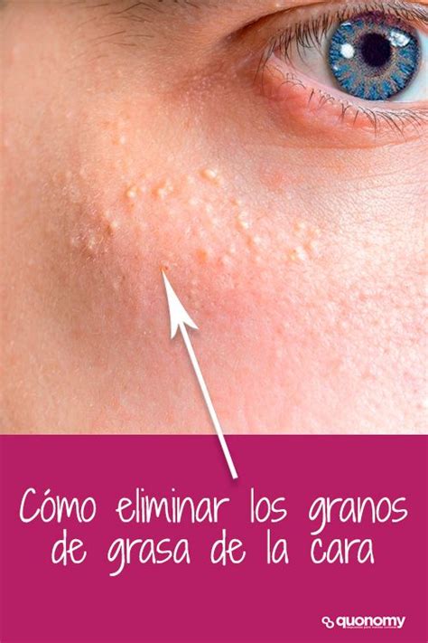 Cómo eliminar los granos de grasa de la cara quistes de milium Como