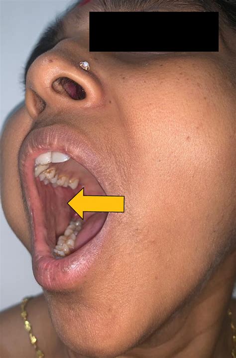 Salivary Glands Inside Lips Lipstutorial Org