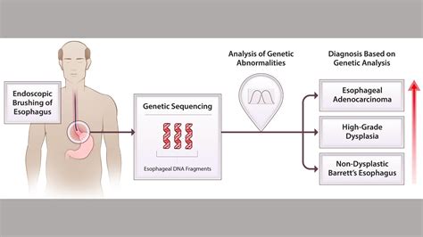 Gene Sequencing Esophageal Brushings Identify Barretts Esophagus