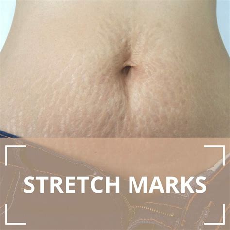 Stretch Marks And Treatment London Premier Laser Clinic