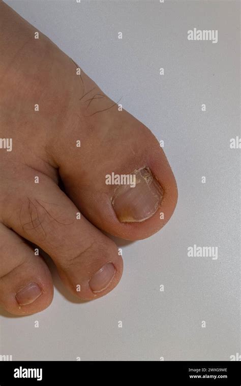 Fungal Nail Infection Onychomycosis Dry Coarse Skin Of The Legs Stock