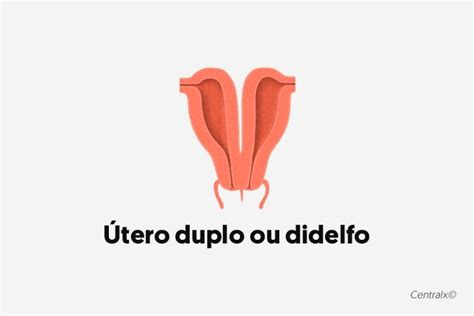 Útero didelfo o que é sintomas causas e tratamento Tua Saúde