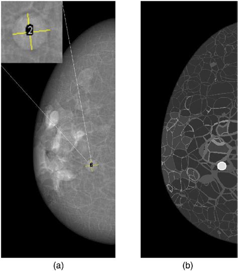 tumor size measured in simulated mammograms for evaluation of the tumor download scientific