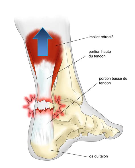 LA RUPTURE DU TENDON DACHILLE SanteSportMagazine
