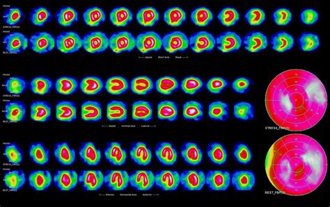 Scintigraphie myocardique à Grenoble Centre de médecine nucléaire à