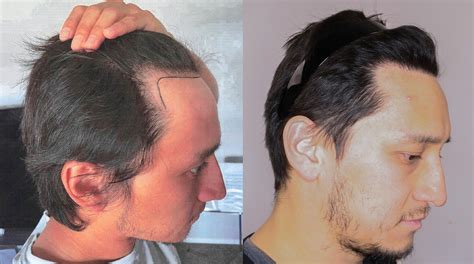 Fall Guy Hair Restoration Alvi Armani Hair Transplant Los Angeles