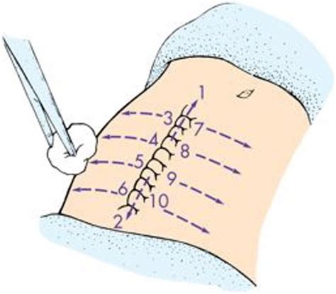 Wound Care Flashcards Quizlet