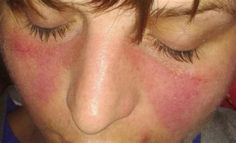 Chi è lo specialista che cura la malattia del lupus LES Torrinomedica