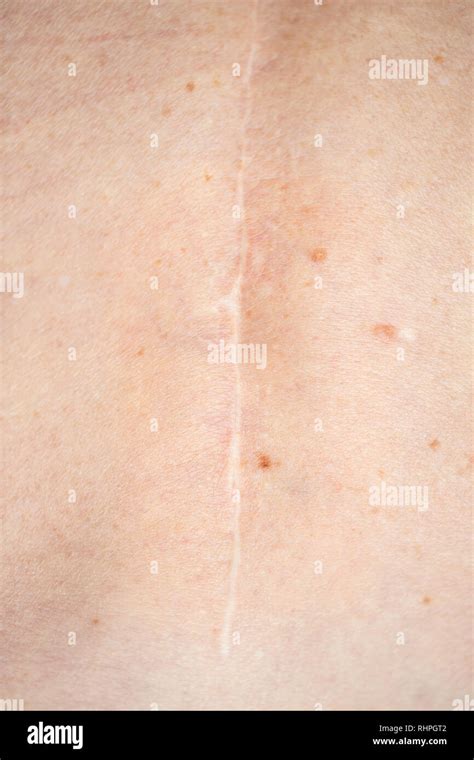 Back Surgery Hi Res Stock Photography And Images Alamy