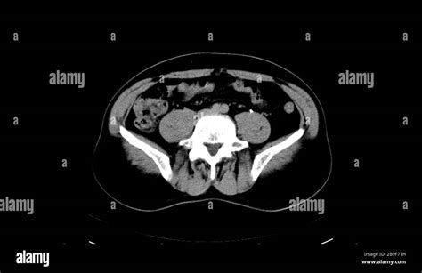 Abdomen Ct Scan Examination Hi Res Stock Photography And Images Alamy