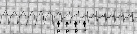 Taquicardia Atrioventricular The Best Porn Website