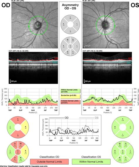 retinal nerve fiber layer analysis from spectralis oct heidelberg download scientific diagram