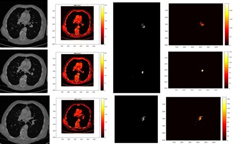 detection and quantification of lung nodules using 3d ct images international journal of