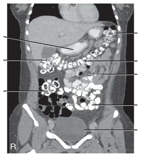 Diagram Of Coronal Abdominal Ct Anatomy Quizlet