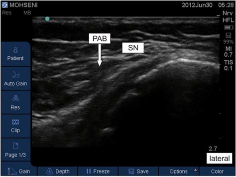 Pes Anserine Bursa Pab Lies Under The Pes Anserine Tendons Sn
