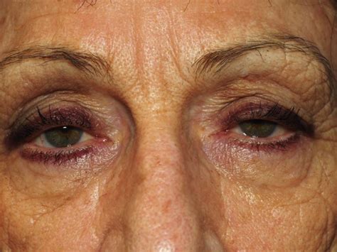 Pathologies Chirurgie de la paupière à Lyon