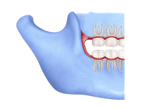 Cirugía de Cordales o Muelas del Juicio Cirugía Oral y Maxilofacial